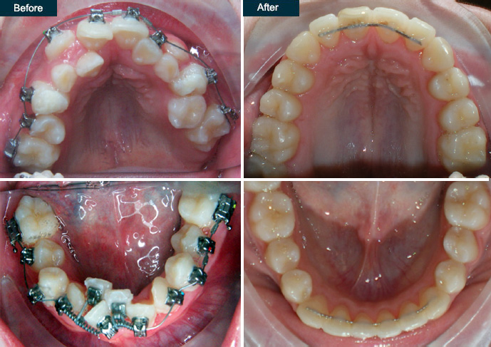Which Are The Best Teeth Straightening Solutions For Adults 