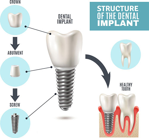 Dental Implants in the Bronx | Best Quality Teeth Implants | Top Dentists