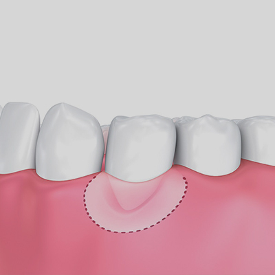 Gum Graft Procedure in the Bronx, NY
