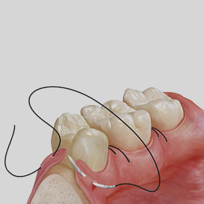 Osseous Surgery in Bronx, NY | Top Rated Periodontist