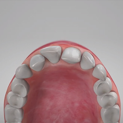 Overlapping Teeth Treatment in the Bronx, NY | Invisalign Provider